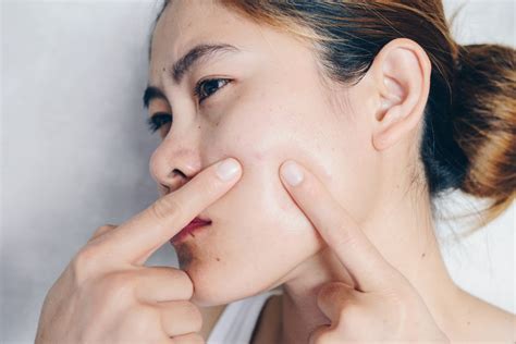 How To Get Rid Of A Popped Pimple Scar Diy Cosmetics