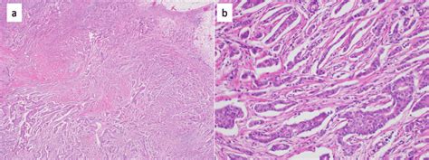 Microscopy Image Of Partial Mastectomy Specimen Of The Left Breast He