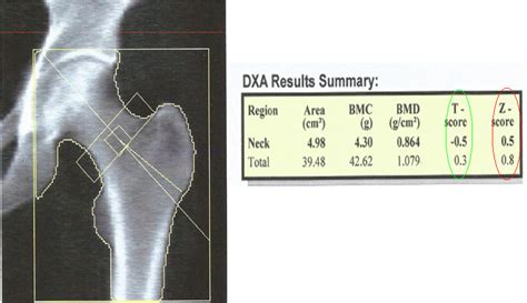 What Is Bone Density Test