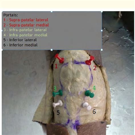 Unresolved Osgood Schlatter Treatment Algorithm Download Scientific