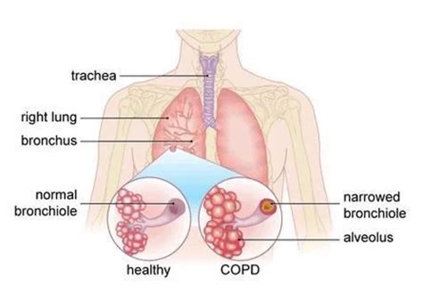 Chronic Obstructive Pulmonary Disease