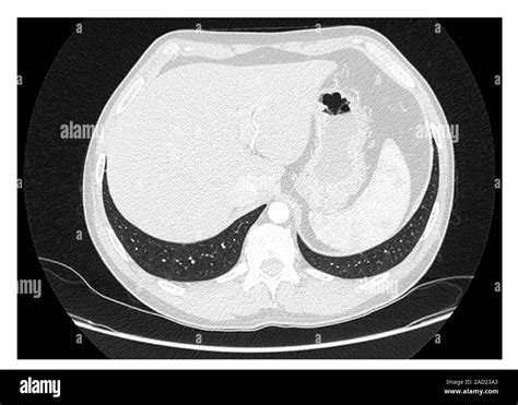 Illustration Of The Lungs Pulmonary Segmentation In Thoracic Ct This