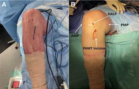 Right Knee View Landmarks For Proximal Anteromedial Tibia Pamt