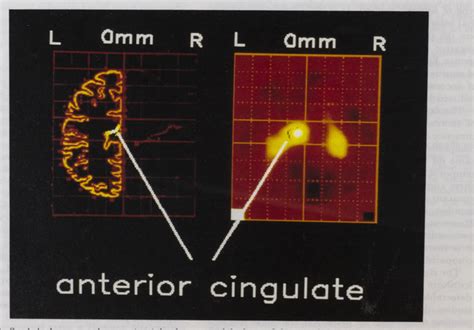 Lentiform Nucleus Structure Semantic Scholar