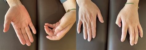 脳卒中（脳梗塞・脳出血など）発症後の手の浮腫（むくみ）とそのリハビリについて お知らせ・ブログ｜脳梗塞・整形疾患等の後遺症改善特化型リハビリ施設 リハビリベース国分寺