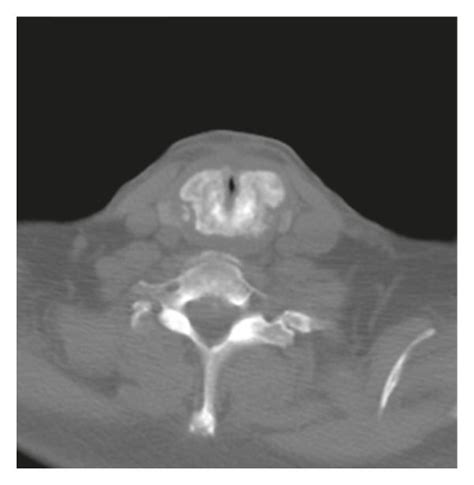 Ct Scan With Axial Sections Showing Enlargement And Generalized