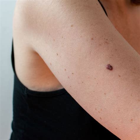 Early Stage Melanoma Pictures