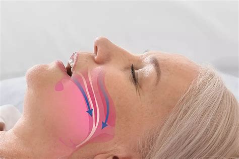 Sleep Apnea Chino California Dr Rakesh Patel Dds