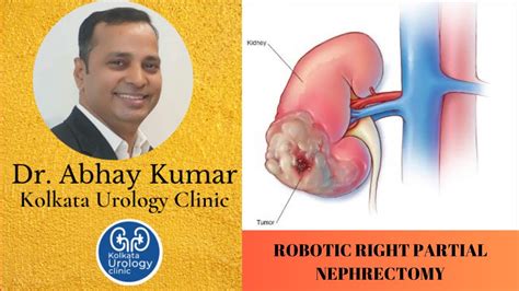 Robotic Right Partial Nephrectomy Youtube
