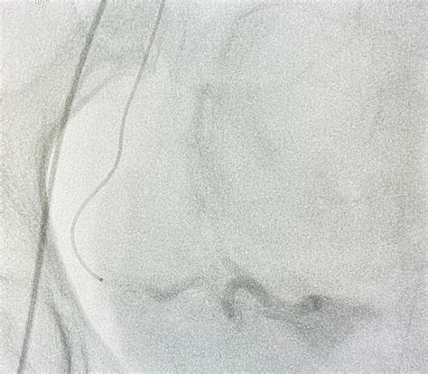 Fibroids The Vascular And Endovascular Clinic