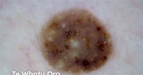 Polarised Dermoscopy Of Seborrhoeic Keratosis Image