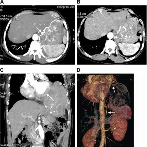 Enhanced Chest Ct Scan Reconstructed Coronal Ct Image And