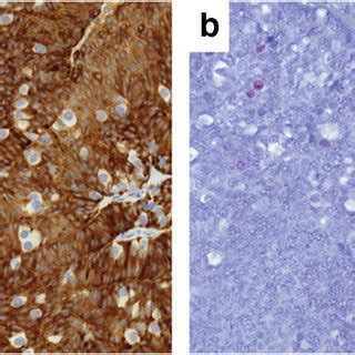The Sex Cord Stromal Component Reacted Diffusely With Inhibin A Download Scientific Diagram