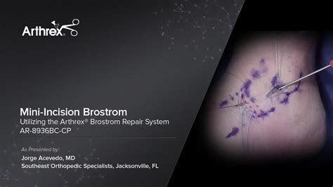 Arthrex Mini Incision Brostrom Utilizing The Arthrex® Brostrom Repair