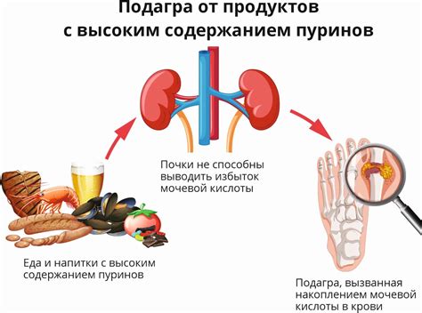 Подагра: что это за болезнь, признаки, причины, симптомы, диагностика ...