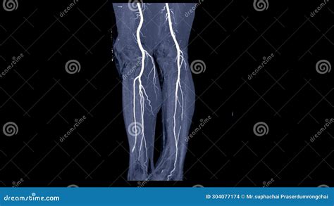 Cta Femoral Artery Run Off Image Of Femoral Artery For Diagnostic Acute Or Chronic Peripheral