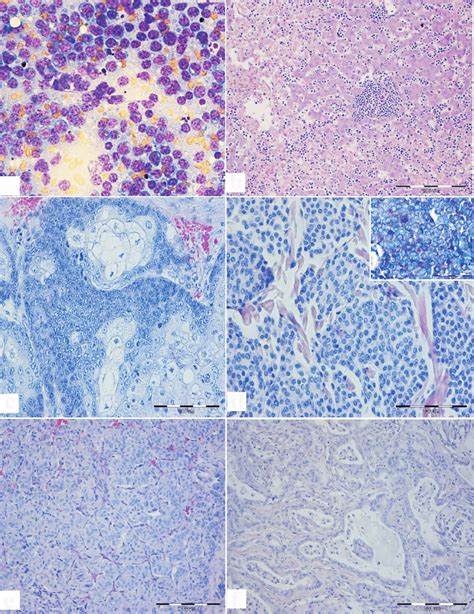 Neoplasms A Aspirate Of An Enlarged Subcutaneous Lymph Node Download Scientific Diagram