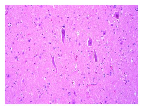 A Focus Of Enlarged Dysmorphic Neurons Is Located In Cortical Layer 3 Download Scientific