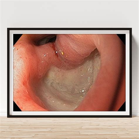 Ulcer In The Duodenum Poster By Science Photo Library Science Photo