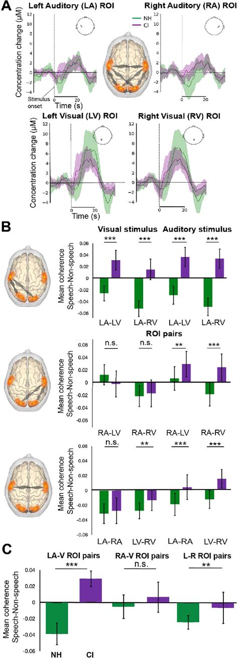 Figure 5 From Cross Modal Functional Connectivity Supports Speech Understanding In Cochlear