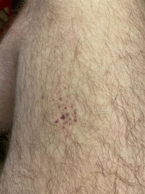 Red Dots On Leg I Looked It Up And Saw Leukemia As A Possible Cause So