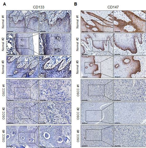 Protein Expression Levels Of Cd133 And Cd147 In Primary Oscc Tumors And