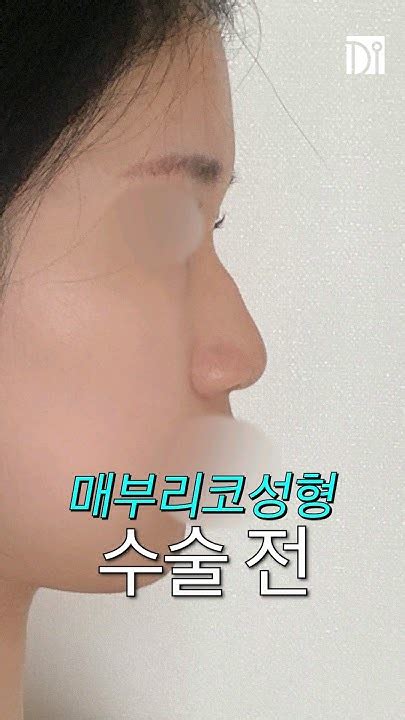 여자 매부리코성형하고 이미지 완전 여주재질🤭 Shorts 자려한코 첫코수술 코재수술전문 Youtube
