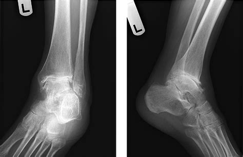 Figure 1 From Post Traumatic Ankle Arthritis Semantic Scholar
