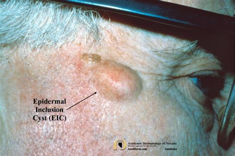 Epidermal Inclusion Cysts Eic Epidermoid Cysts Academic