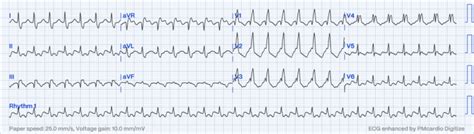 VT Vs Aberrancy A Simpler Approach 1 Cardiac Physiology In Practice