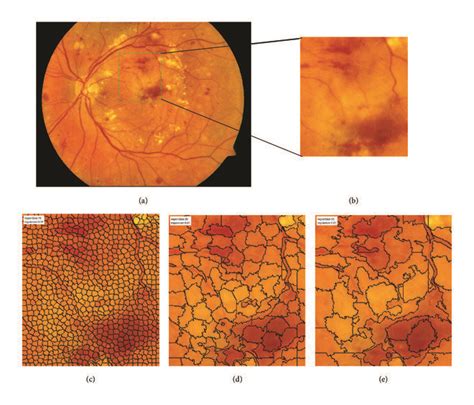 Retinal Image Segmentation Using SLIC A Original Retinal Fundus Download Scientific Diagram