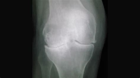 Knee Osteoarthritis Management For Gps 2025 Updated Dr Oliver Khoo