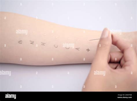 Model Released Allergy Test Arm Of A Twenty Five Year Old Woman Undergoing A Skin Scratch