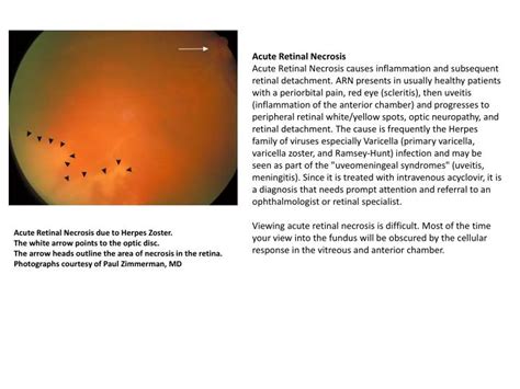 Ppt Acute Retinal Necrosis Powerpoint Presentation Free Download