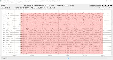 Temple University Eeg Corpus Example0004