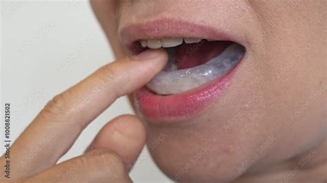 Woman Puts Dental Splint Guard In Her Mouth Tmj Splint Disorder