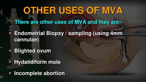 PPT MVA PowerPoint Presentation Free Download ID