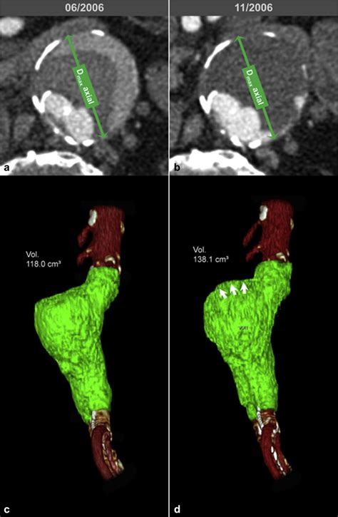 Persistent Type Ii Endoleak After Evar Of Aaa At 2 Day And 6 Month