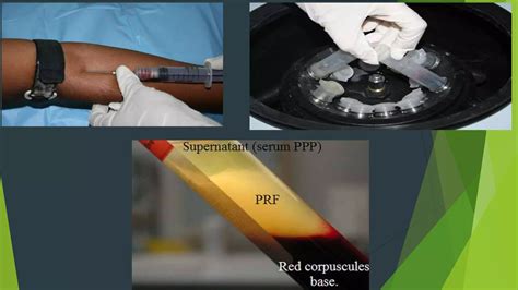 Bone Regeneration In Extraction Sockets With Autologous Platelet Ppt