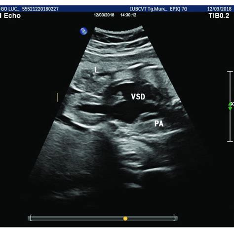 A B Complete Thoracic Ectopia Cordis Fetal Echocardiography At Download Scientific Diagram