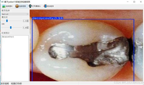 基于yolov11的蛀牙检测系统python源码pytorch模型评估指标曲线精美gui界面 腾讯云开发者社区 腾讯云