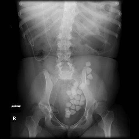 Bladder Stones Buyxraysonline
