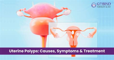 Uterine Polyps Causes Symptoms And Treatment Gobind Fertility And Ivf Centre