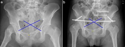 Measurement Of Pelvic Deformity Index Pdi And Pubic Symphyseal Width Measurement Of Pelvic Deformity Index Pdi And Pubic Symphyseal Width