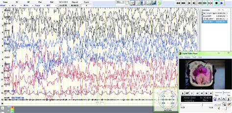 Ictal Eeg Eeg Electroencephalogram Download Scientific Diagram