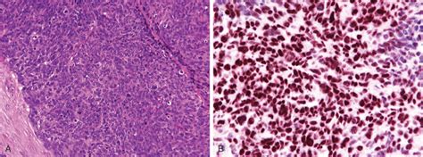 Immunohistology Of Carcinoma Of Unknown Primary Site Basicmedical Key