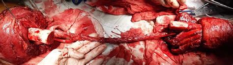 Removal Of Spindle Cell Tumor Of The Tibia Rmedicalgore