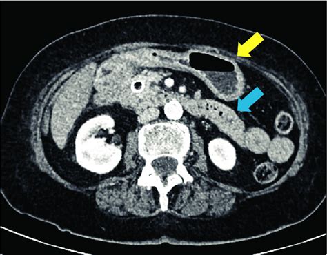 Computed Tomography Scan Showing The Proximity Of The Stomach Yellow Download Scientific