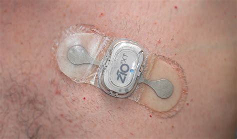 Wearable ECG Monitor Diagnoses AFib Better Than Usual Monitoring Study