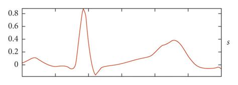 A A Qrs Signal Template B The Idwt Reconstructed Detail Level 6 Download Scientific